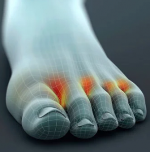 What is athlete's foot, and how can you prevent it? - Primary Medical ...