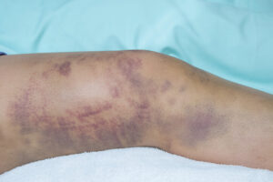 Let’s Talk About ITP - Those Purple Bruises Could Signify Very Low ...